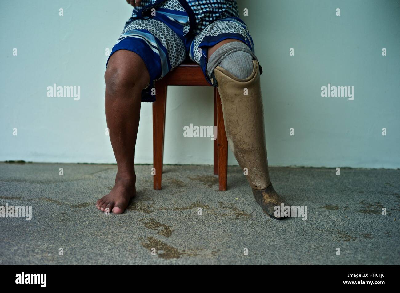 Model released portrait of a Cambodian land mine survivor, who lost an ...