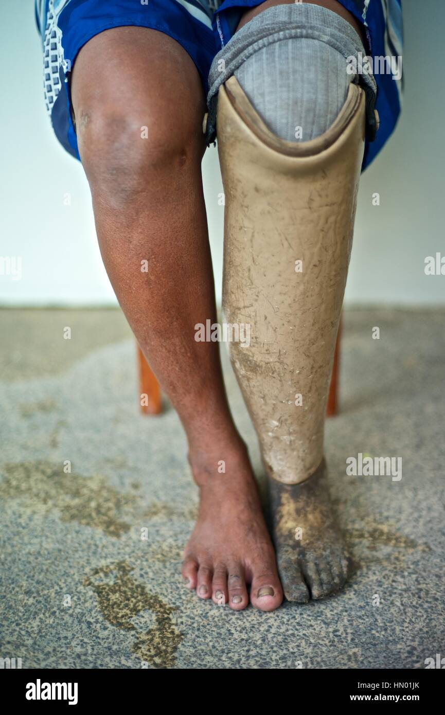 Woman amputee arm hi-res stock photography and images - Alamy