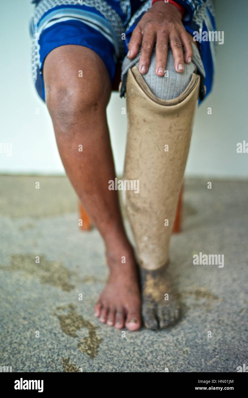 Model released portrait of a Cambodian land mine survivor, who lost an ...