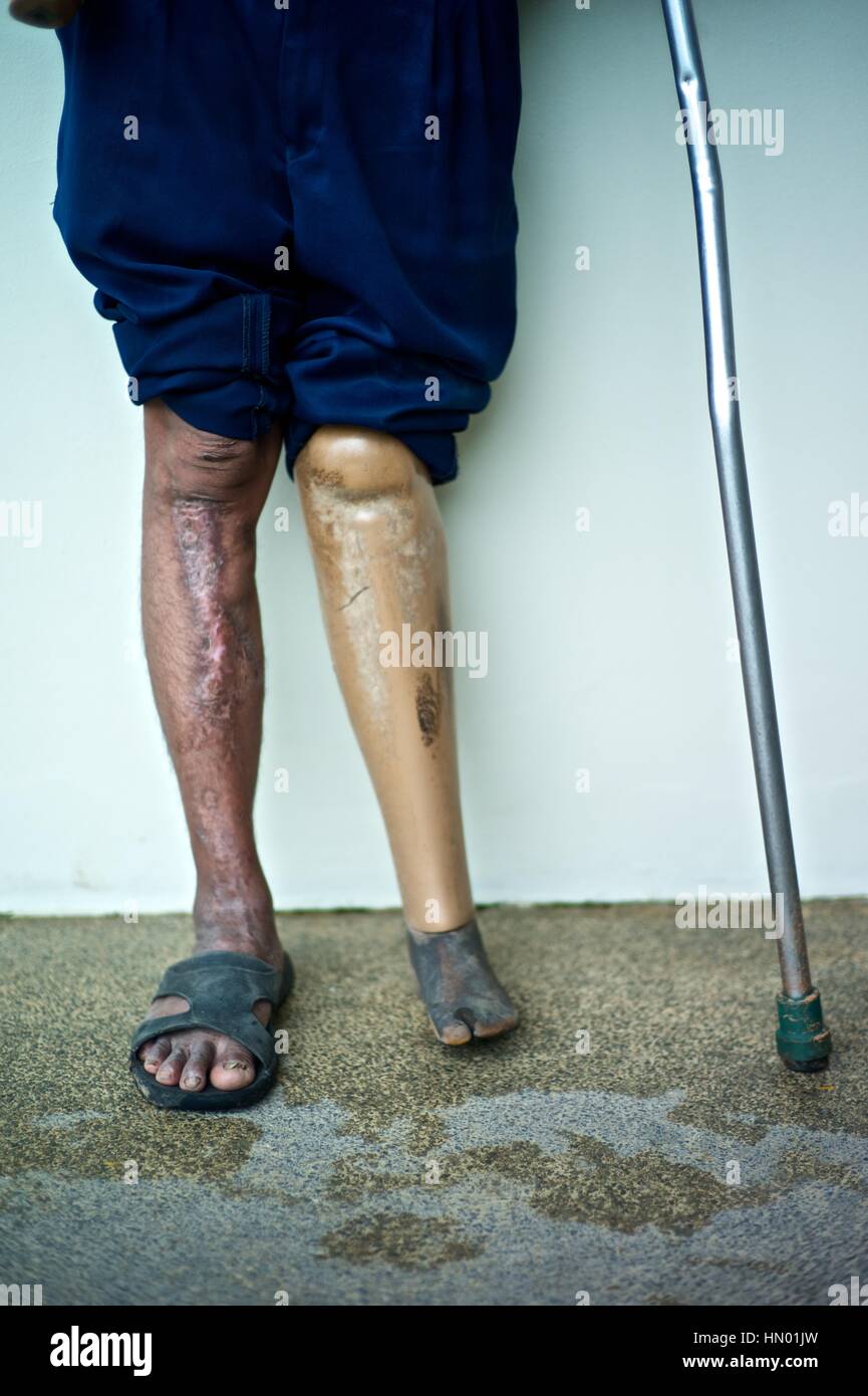 Prosthetic limbs hi-res stock photography and images - Alamy