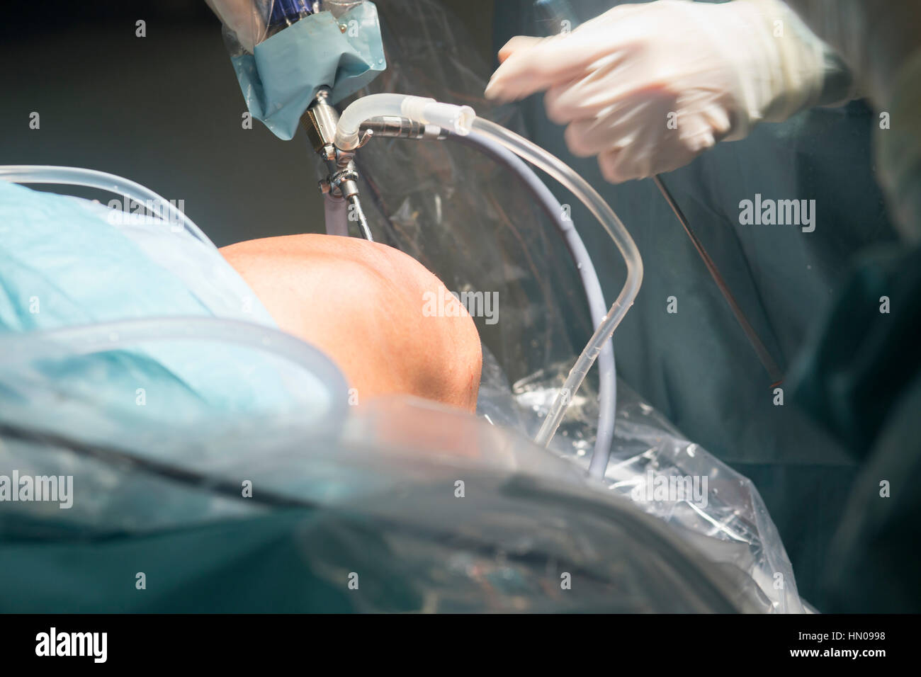 Knee keyhole surgery hospital arthroscopy operation medical procedure ...