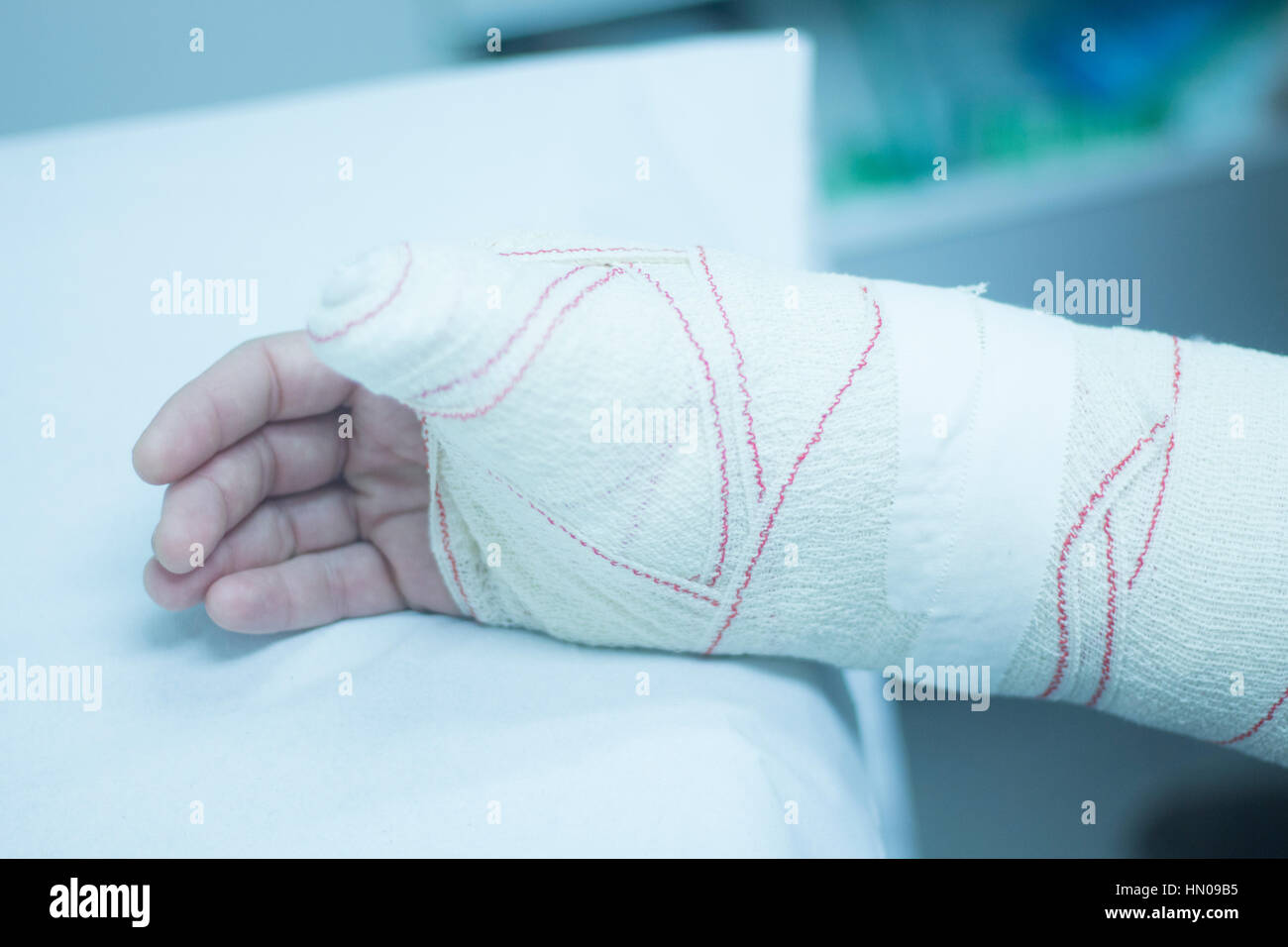 Doctor applying a plaster cast and bandages to patient forearm and ...