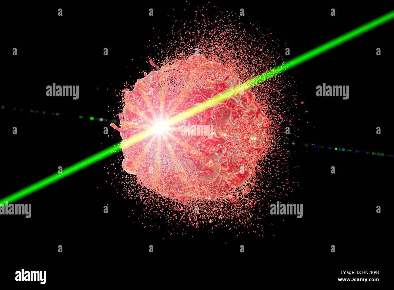 Laser treatment of tumor hi-res stock photography and images - Alamy