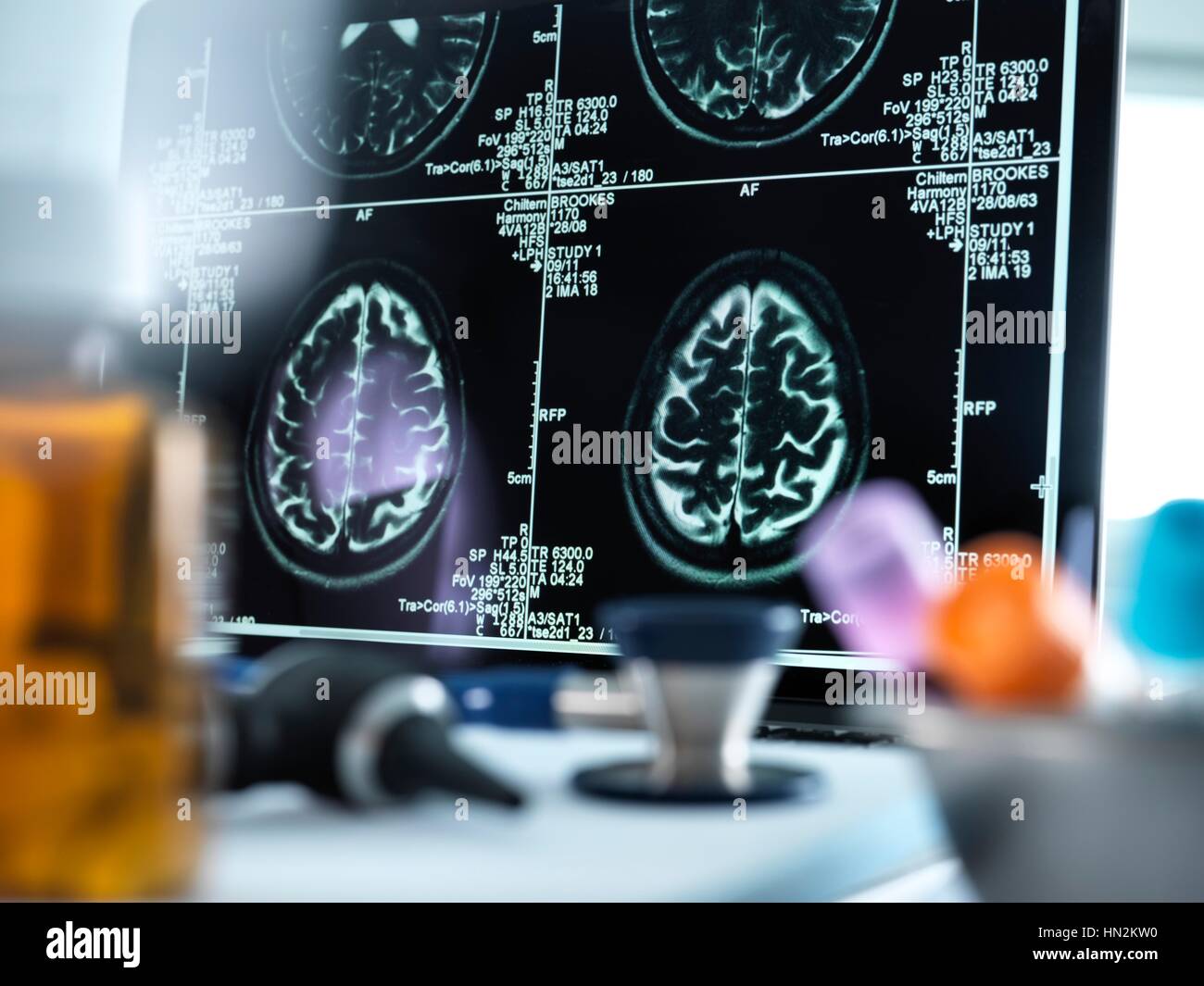 Magnetic resonance imaging (MRI) brain scans displayed on a screen on a ...