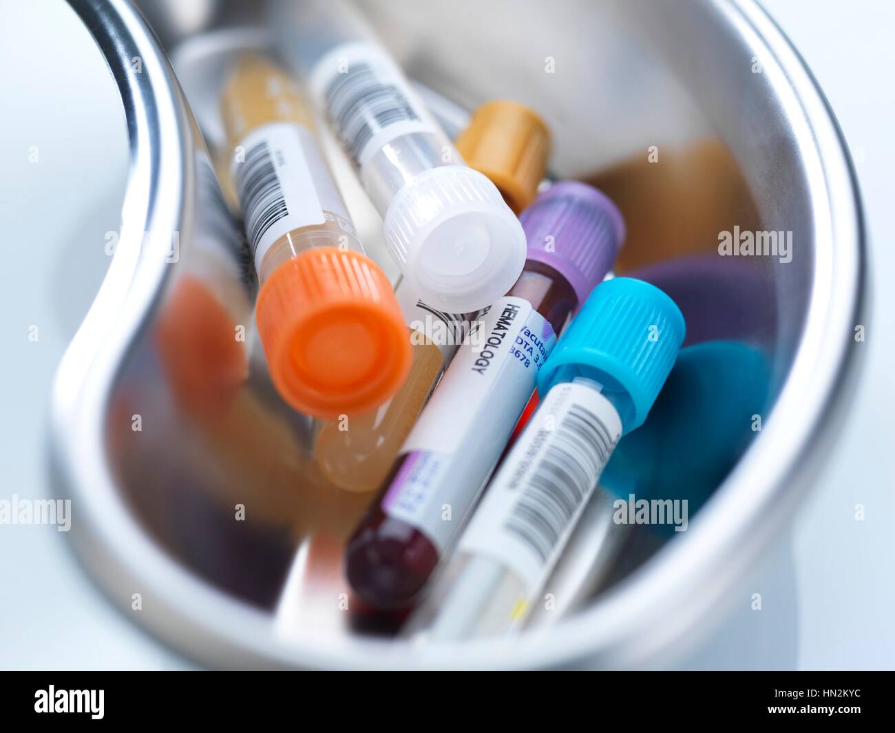 Human medical samples including blood and urine in a kidney shaped bowl ...