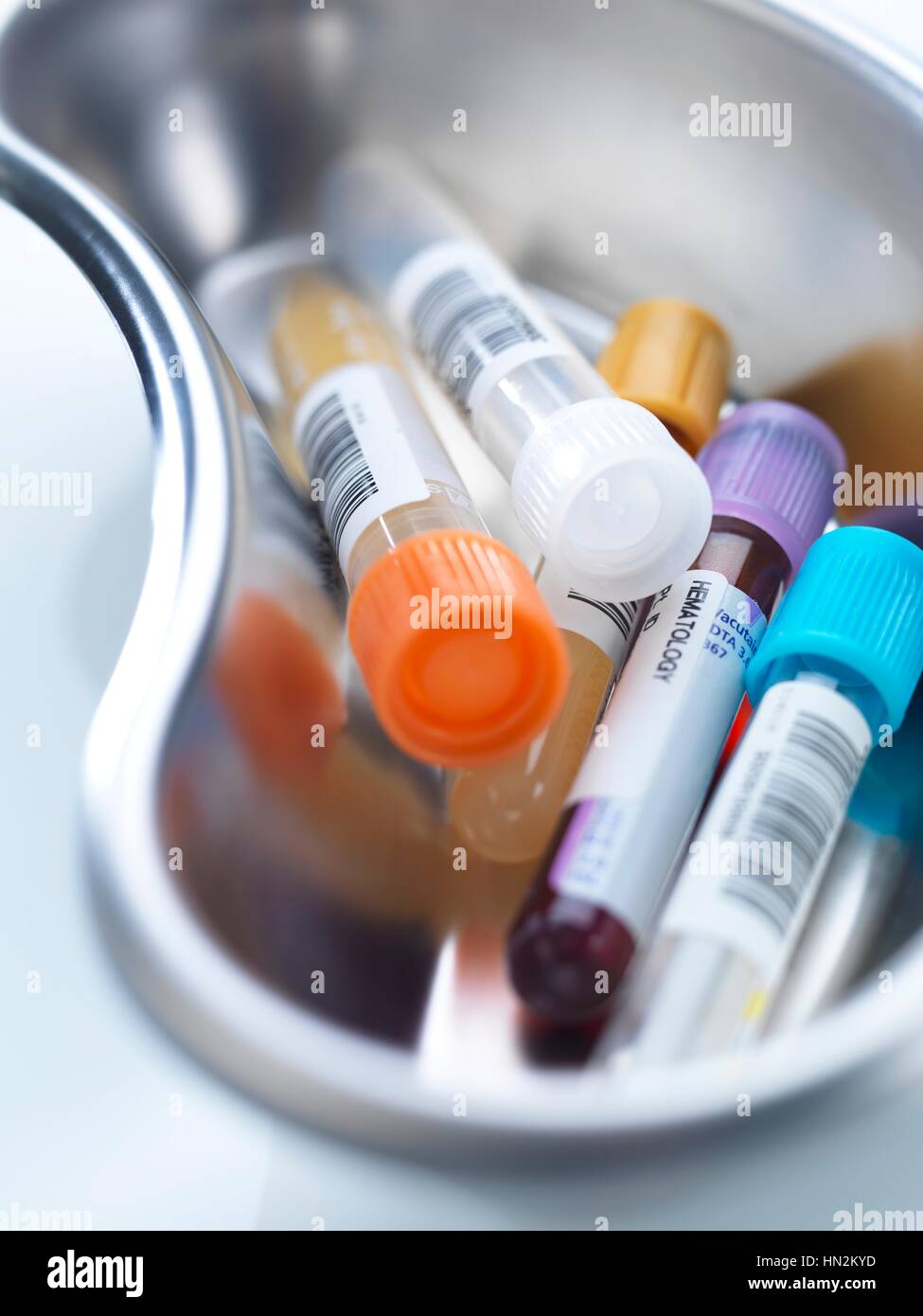 Human medical samples including blood and urine in a kidney shaped bowl ...