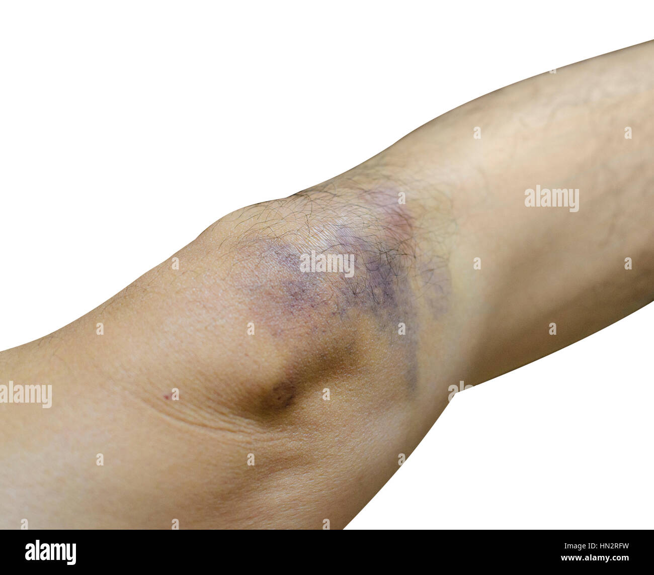 Bruises on leg. Isolated on white background Stock Photo - Alamy