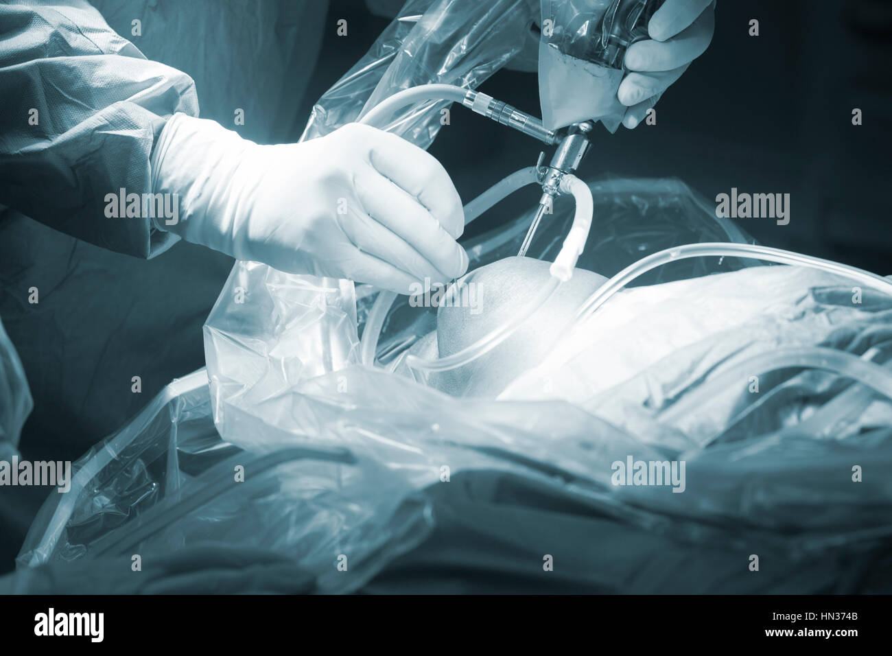 Knee keyhole surgery hospital arthroscopy operation medical procedure ...