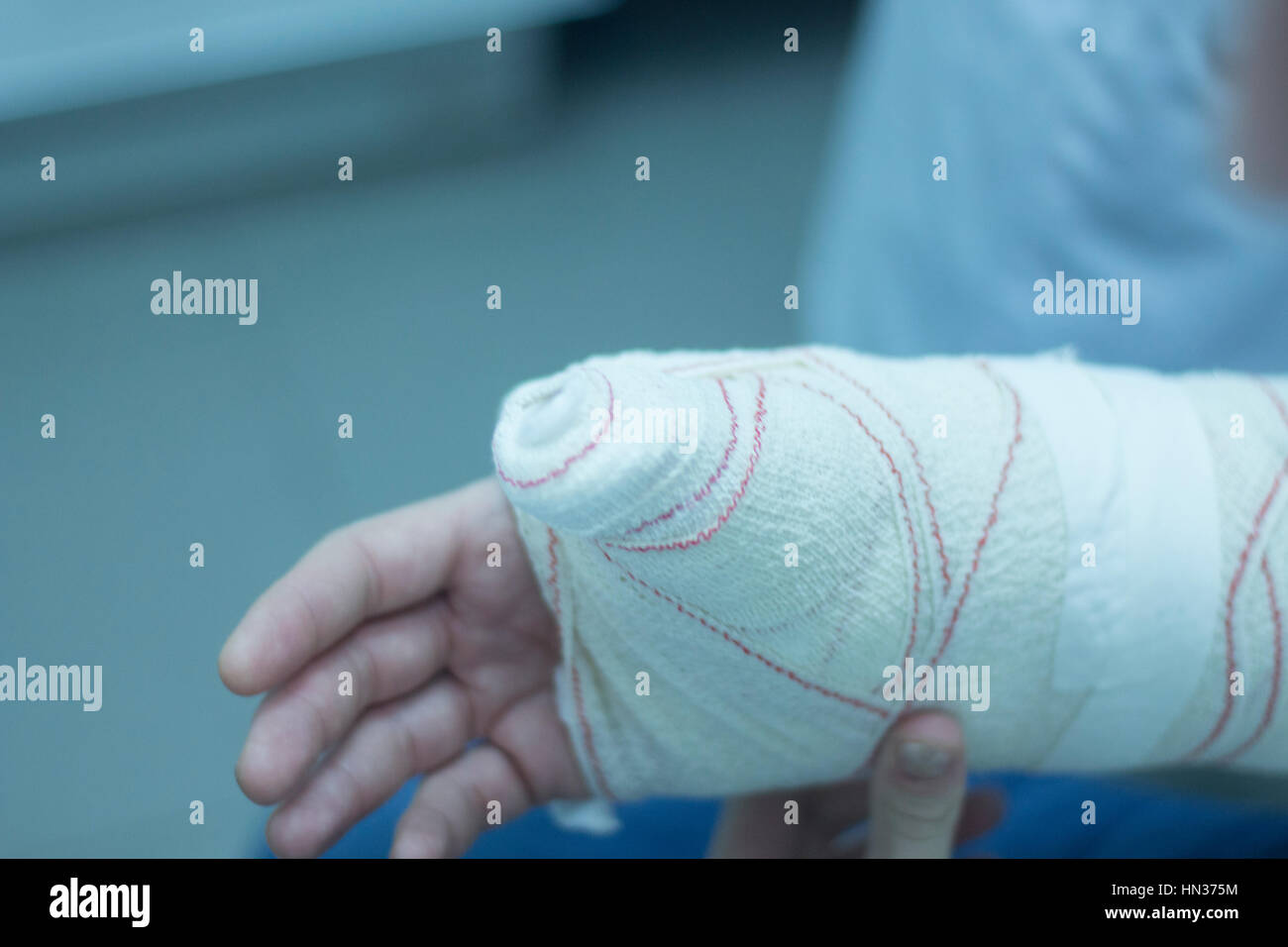Doctor applying a plaster cast and bandages to patient forearm and ...