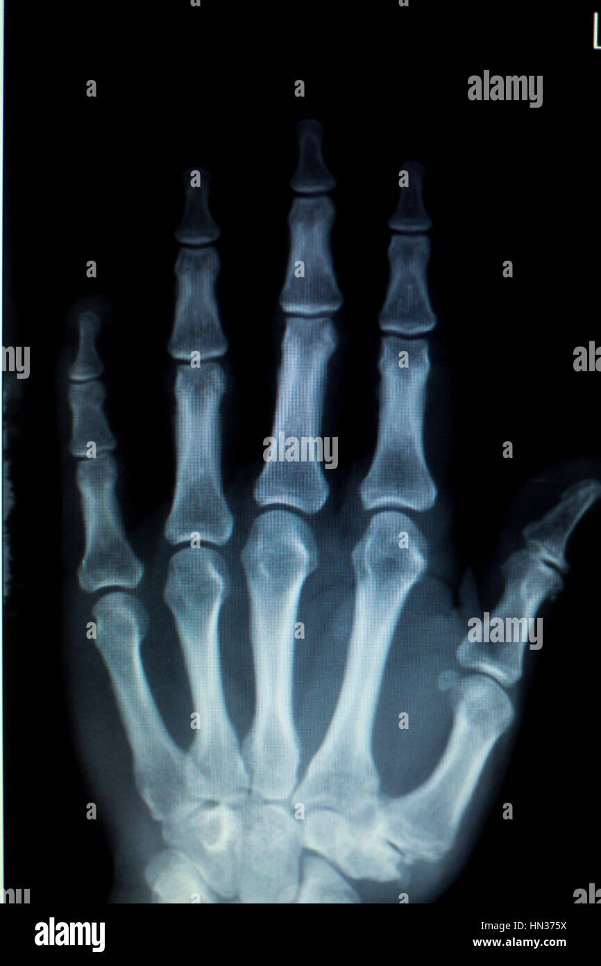 Orthopedics Hand finger joint meniscus, ligament, tendon and cartilage ...