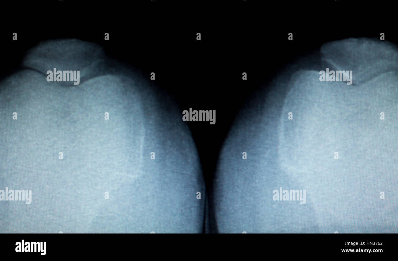 Orthopedics knee joint meniscus, ligament, tendon and cartilage injury ...