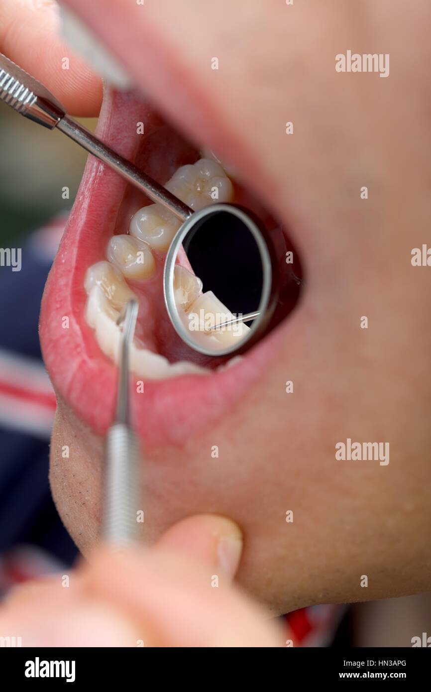 Close up of an extensive dental examination Stock Photo - Alamy