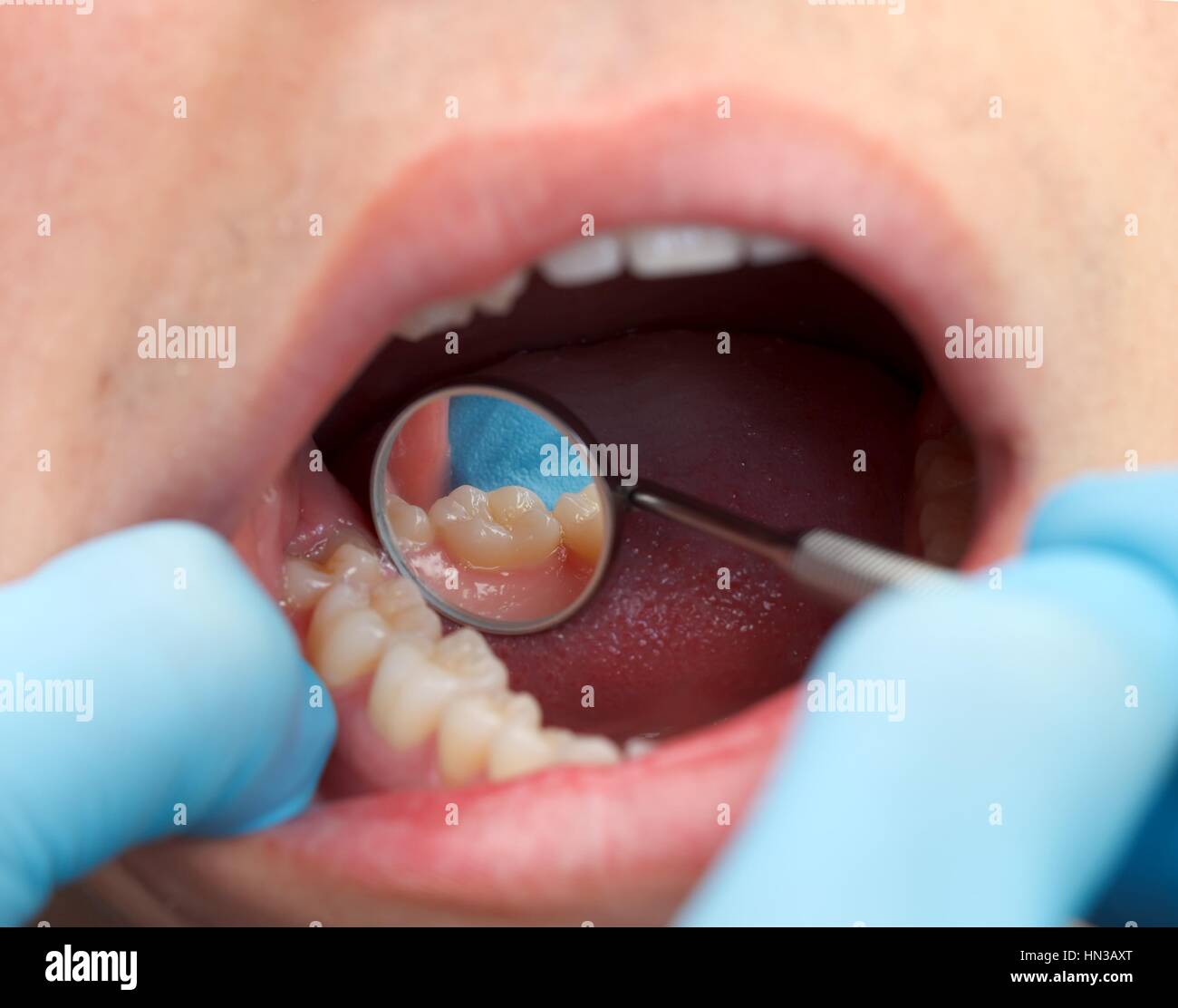 Close up of an extensive dental examination Stock Photo - Alamy