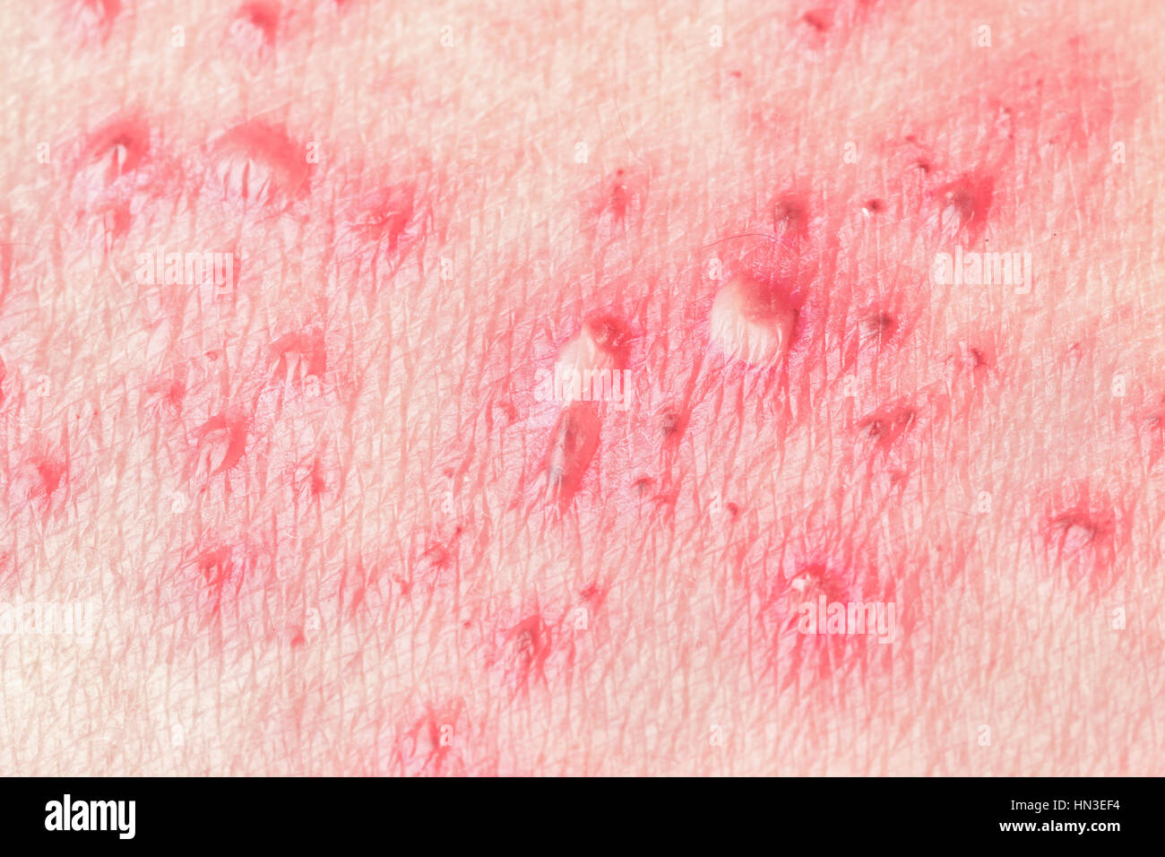 Detail of skin with Herpes Zoster (Shingles Stock Photo - Alamy