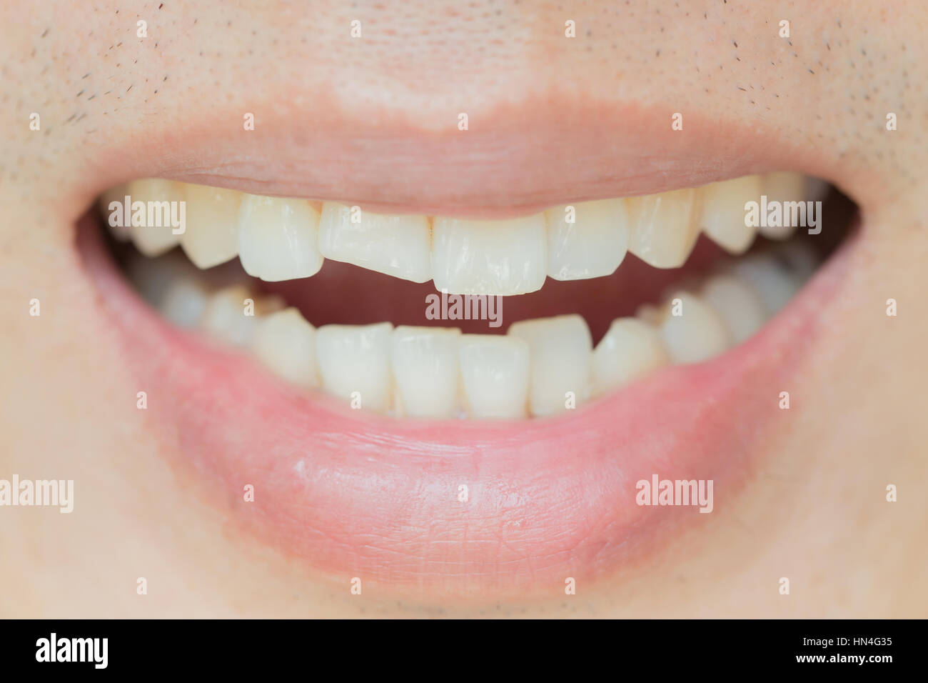 Trauma and Nerve Damage of injured tooth, Permanent Teeth Injury Stock ...