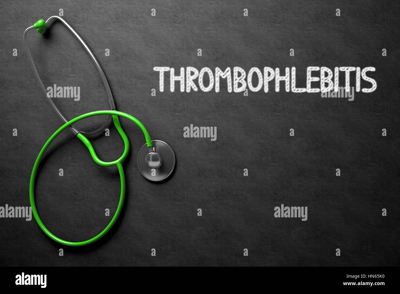 Phlebitis hi-res stock photography and images - Alamy