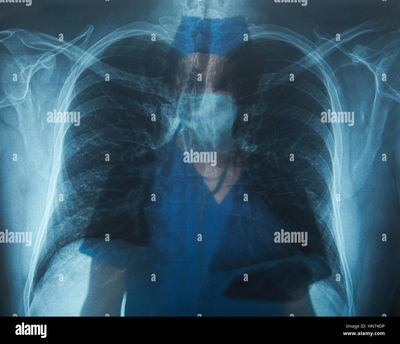Chest radiography lung cancer hi-res stock photography and images - Alamy