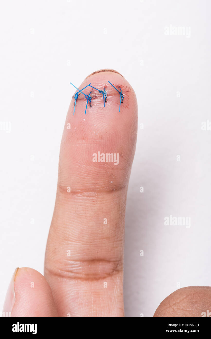 closeup wound with surgical stitch Stock Photo - Alamy