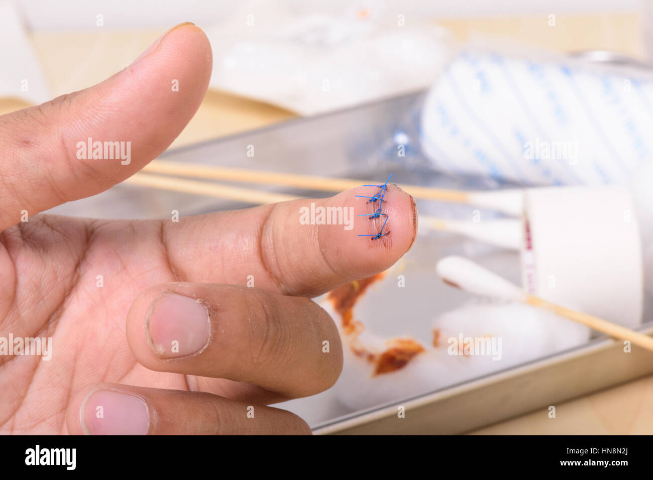 closeup wound with surgical stitch Stock Photo - Alamy