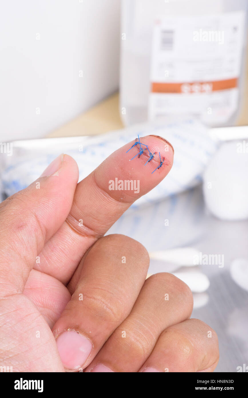 closeup wound with surgical stitch Stock Photo - Alamy