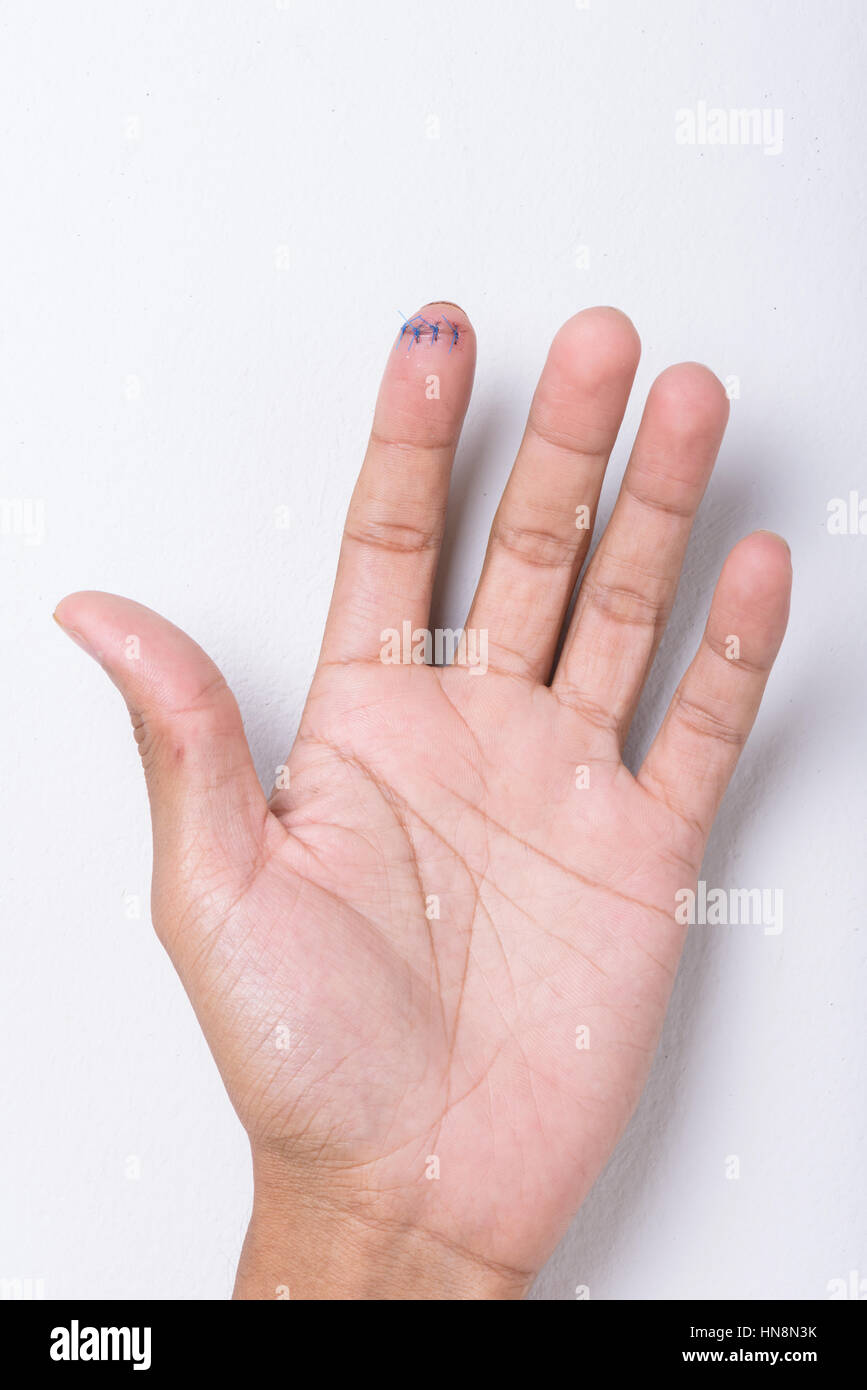 closeup wound with surgical stitch Stock Photo - Alamy