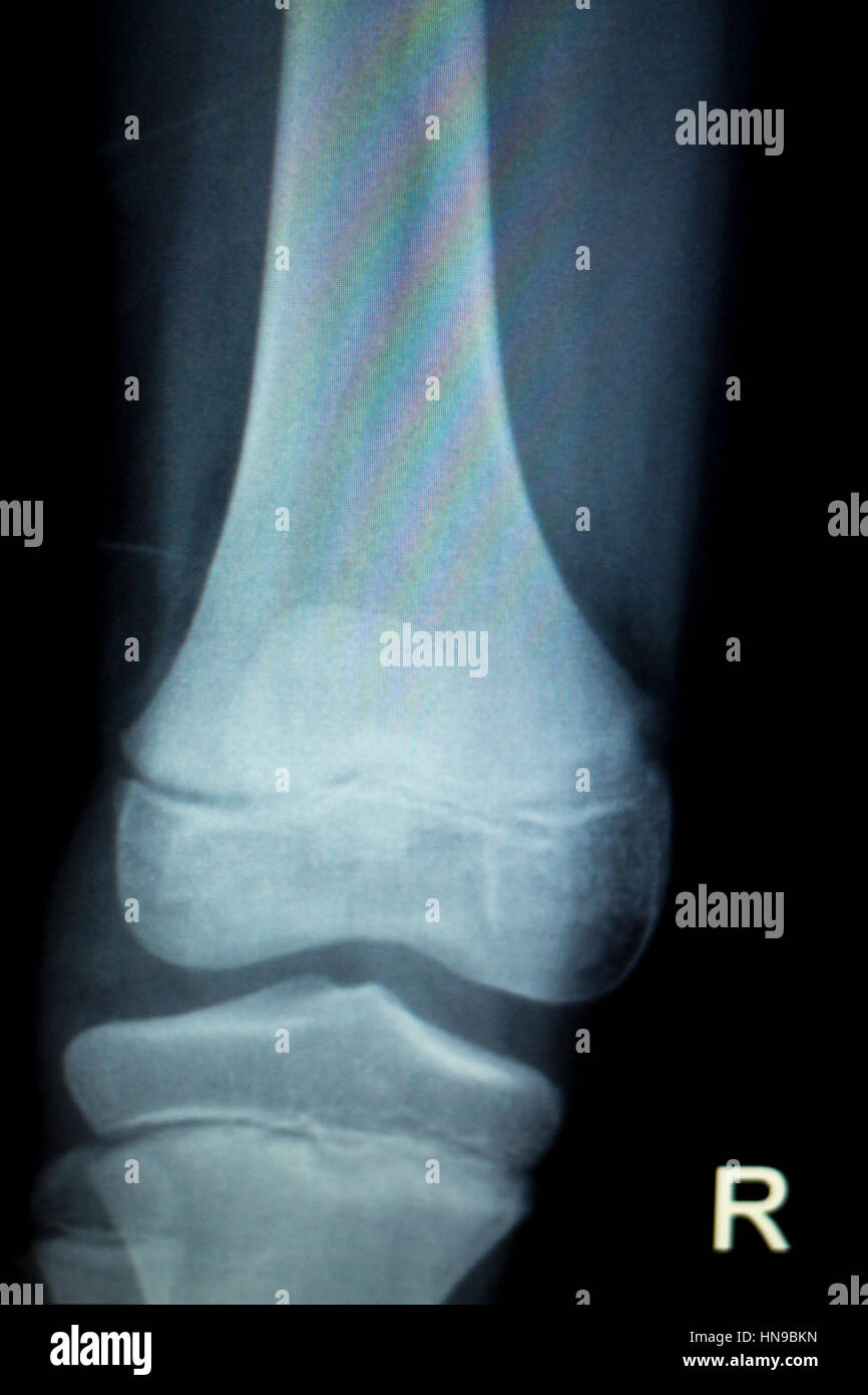 Orthopedics knee joint meniscus, ligament, tendon and cartilage injury ...