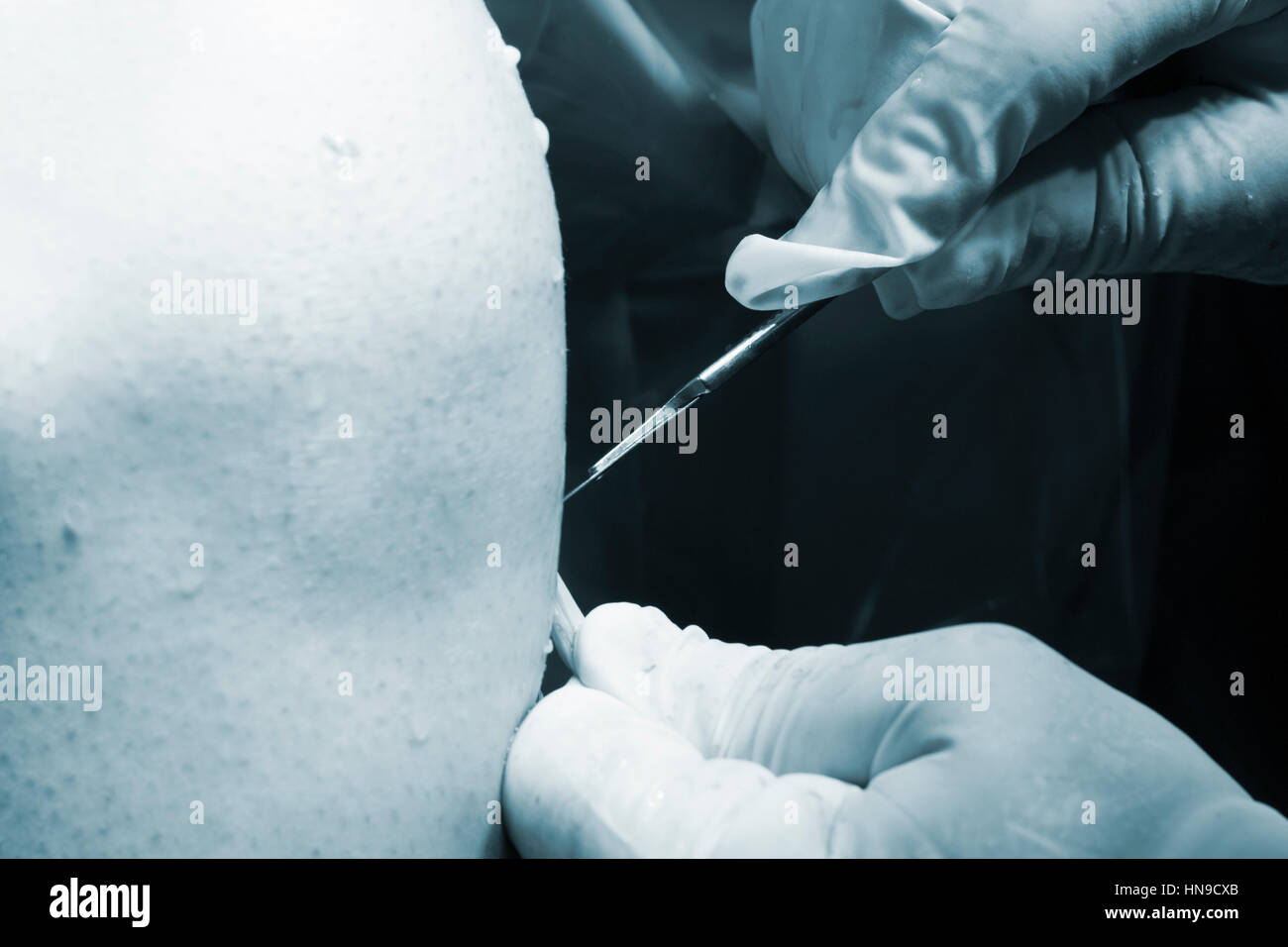 Surgical operation knee arthroscopy micro surgery in hospital operating ...