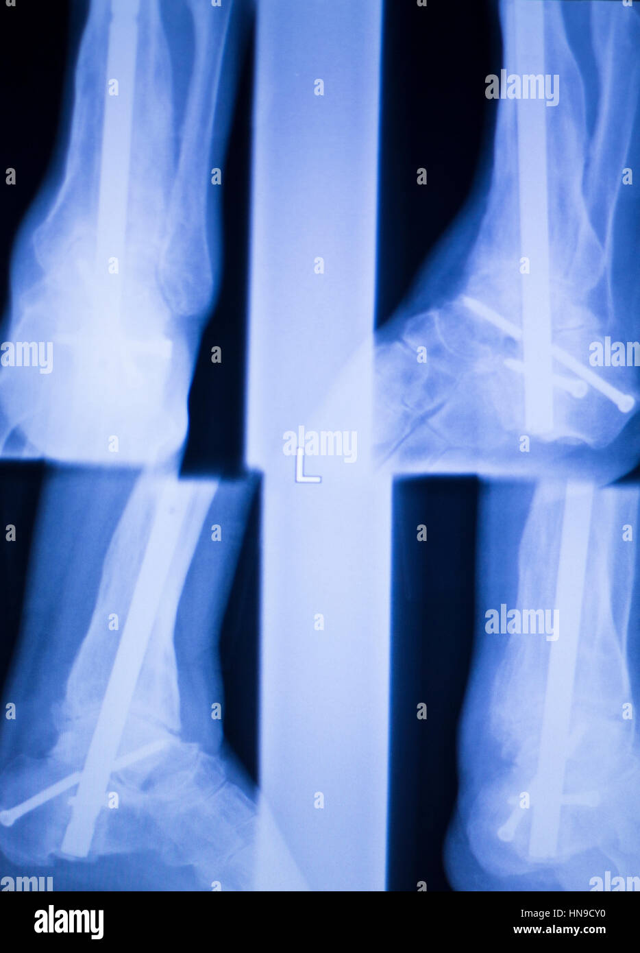 Xray foot heel ankle test scan results showing orthopedic titanium ...