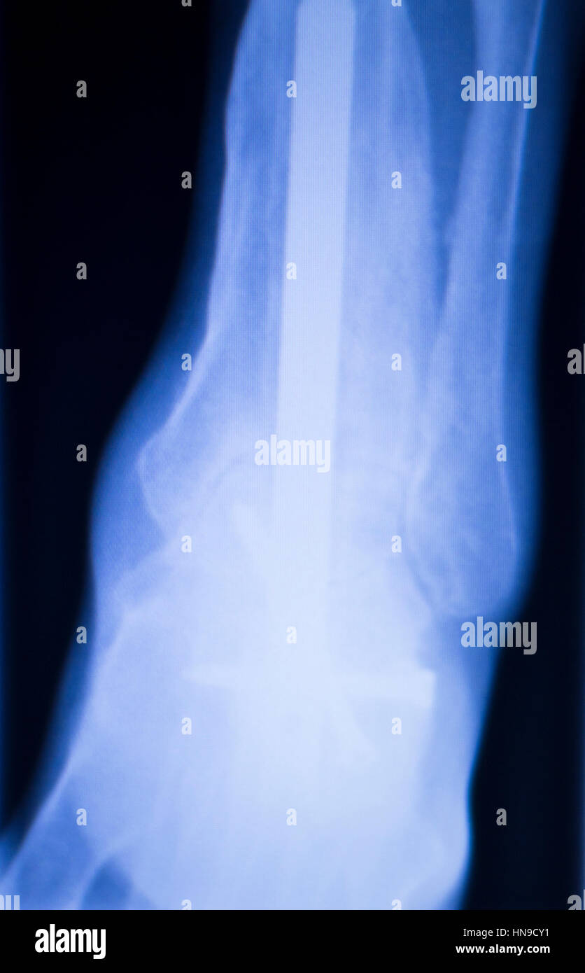Xray foot heel ankle test scan results showing orthopedic titanium ...