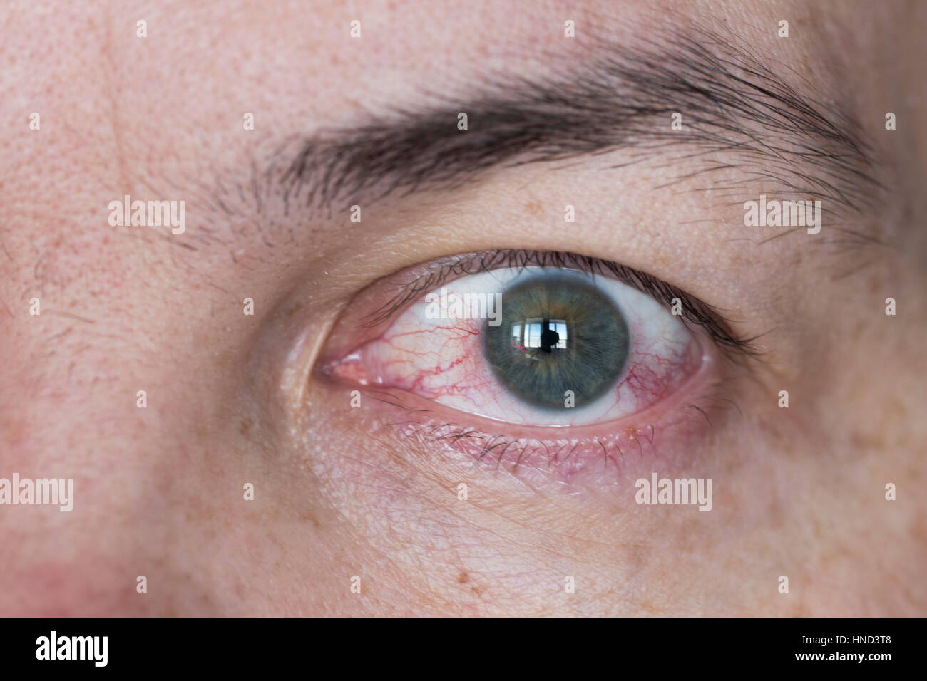Close up of wide open red and irritated eye Stock Photo - Alamy