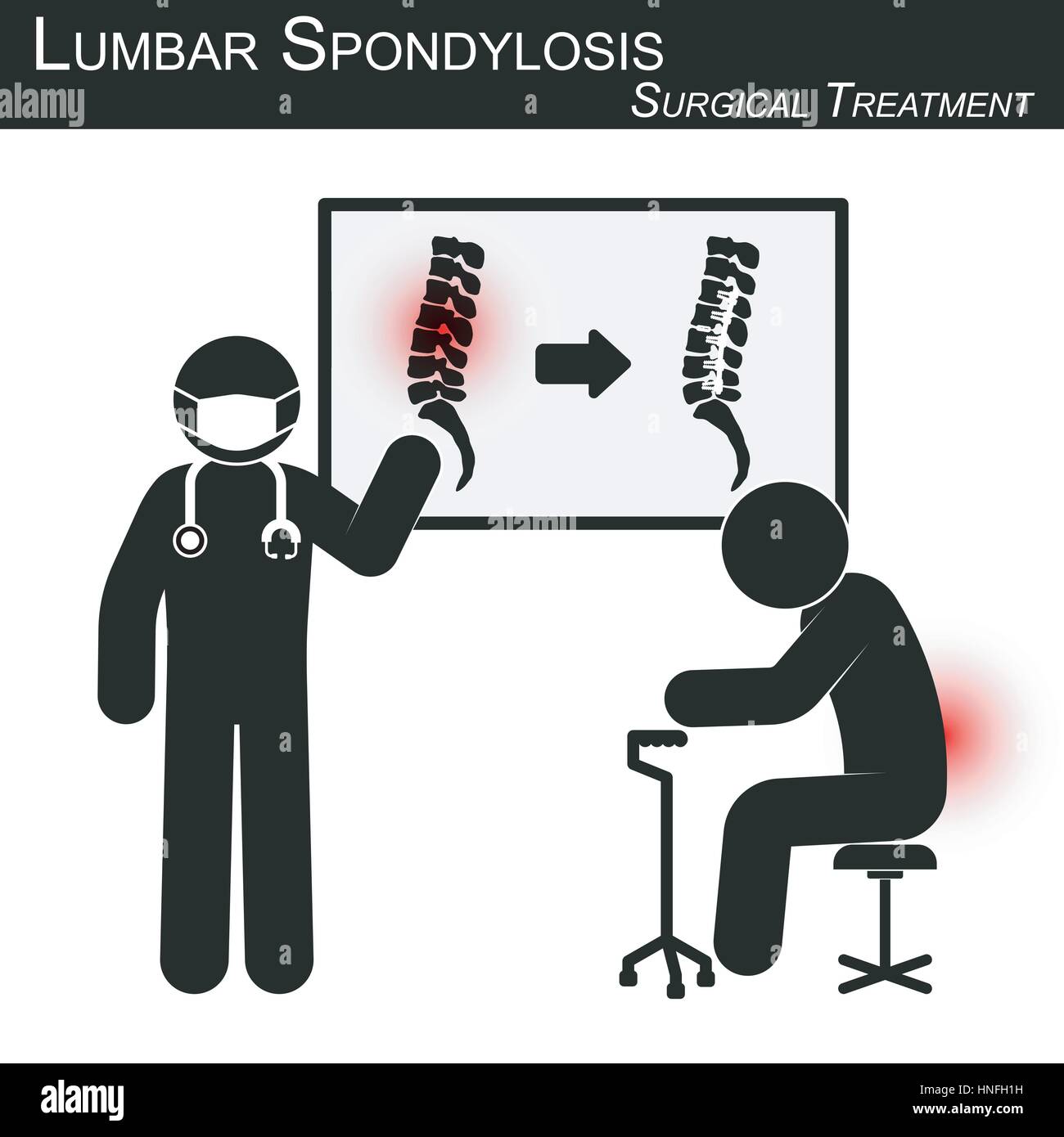 Doctor explain about surgical treatment of lumbar spondylosis and show ...