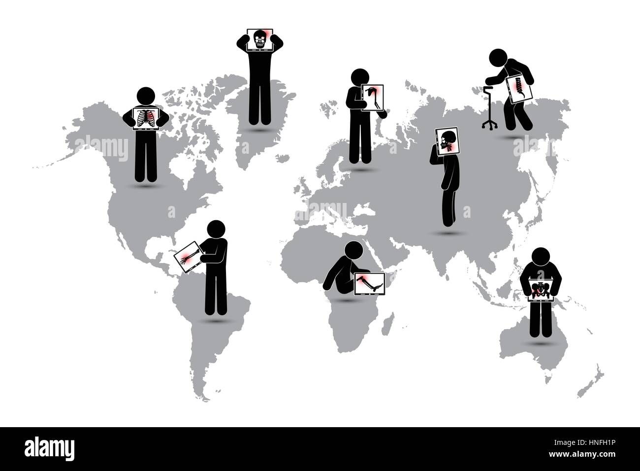 Tuberculosis lung map hi-res stock photography and images - Alamy