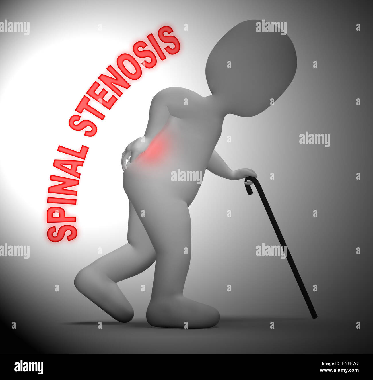 Lumbar spinal stenosis hi-res stock photography and images - Alamy