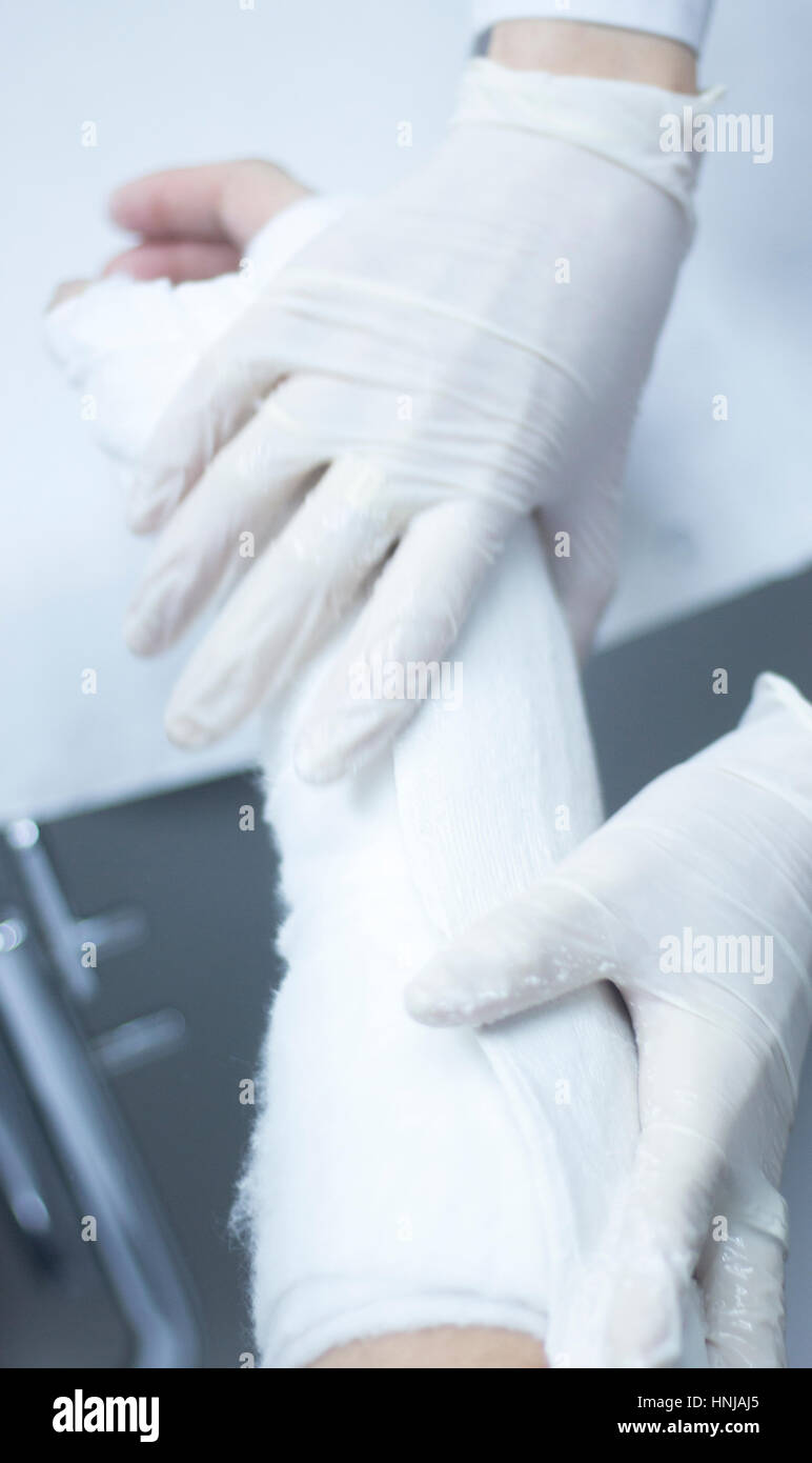 Doctor applying a plaster cast and bandages to patient forearm and ...