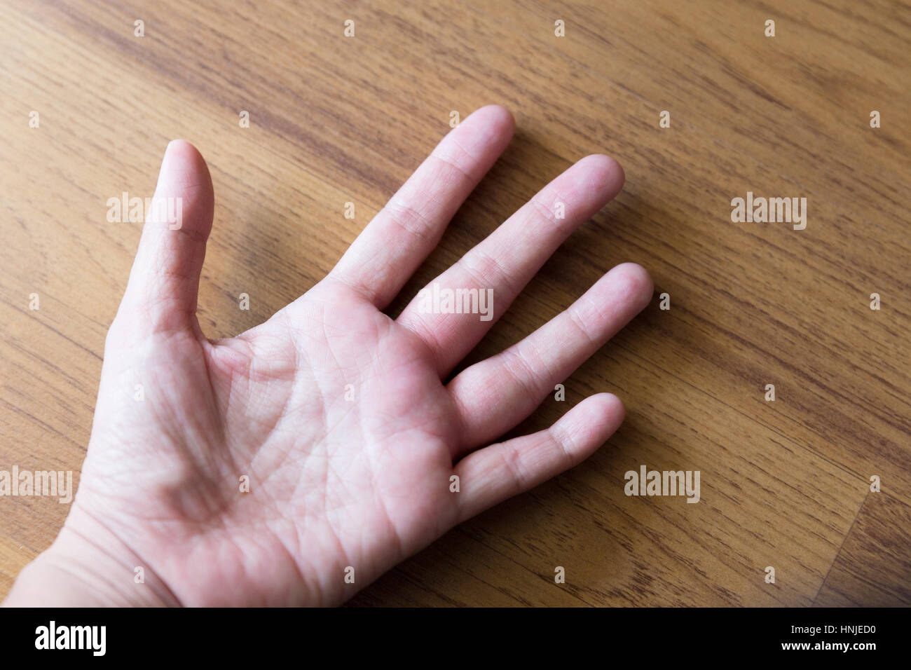 Wasp sting hand hi-res stock photography and images - Alamy