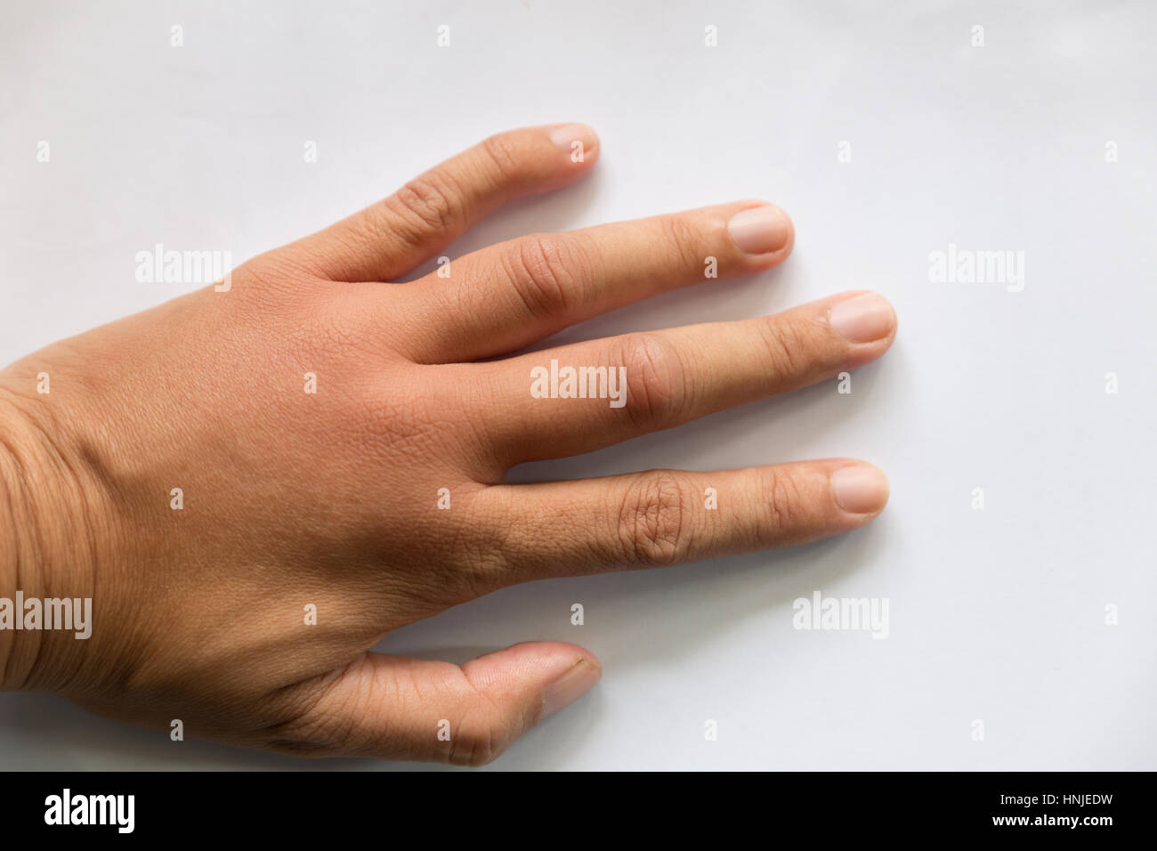 swollen hand from wasp insect sting Stock Photo - Alamy