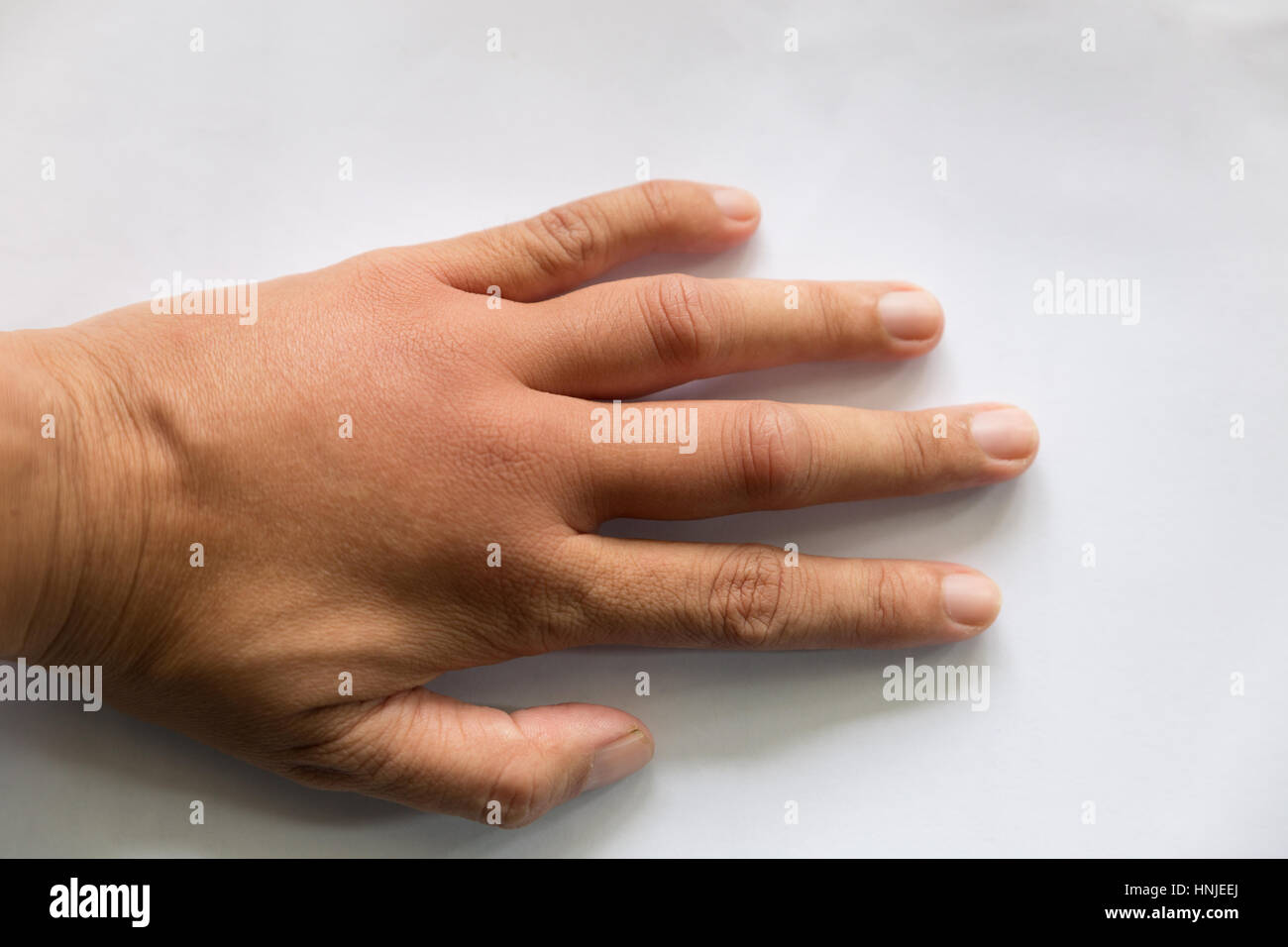 Wasp sting hand hi-res stock photography and images - Alamy