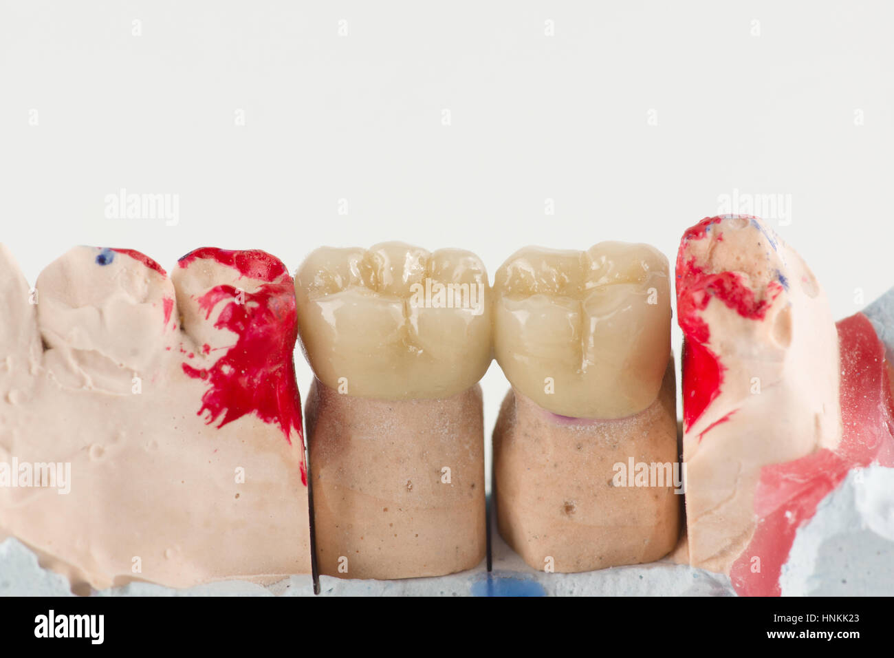 ceramic crowns to try on a tooth model for restoring decayed teeth ...