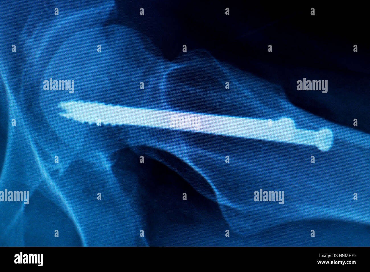 Orthopedic hip plate and bone screw hi-res stock photography and images ...