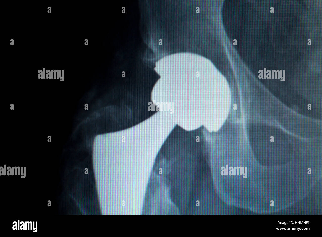 Orthopedics knee joint titanium modern metal implant replacement with ...