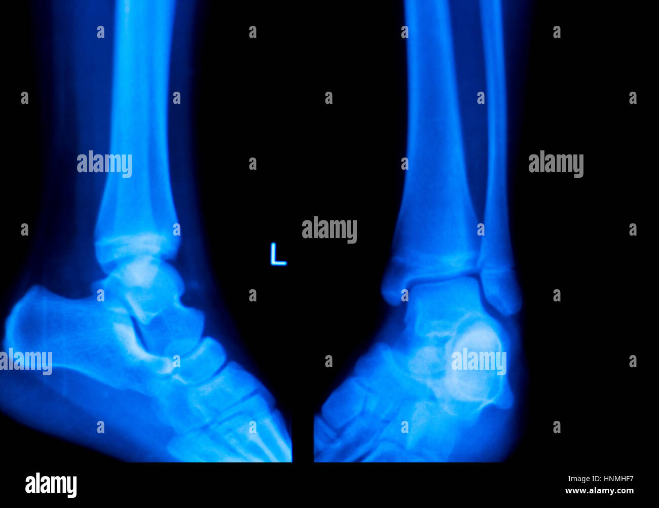 Xray foot heel ankle test scan results showing orthopedic titanium ...