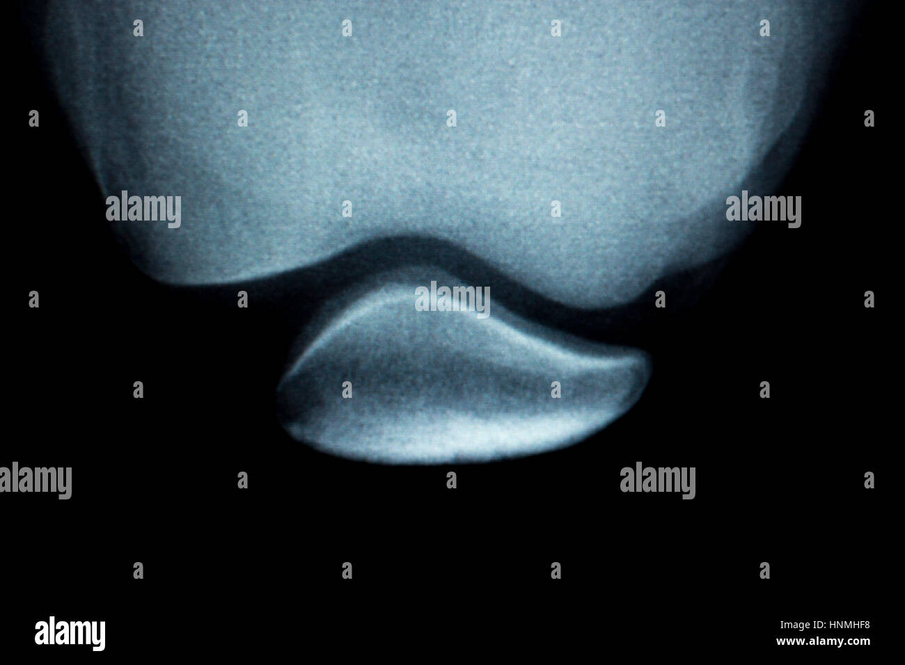 Orthopedics knee joint meniscus, ligament, tendon and cartilage injury ...