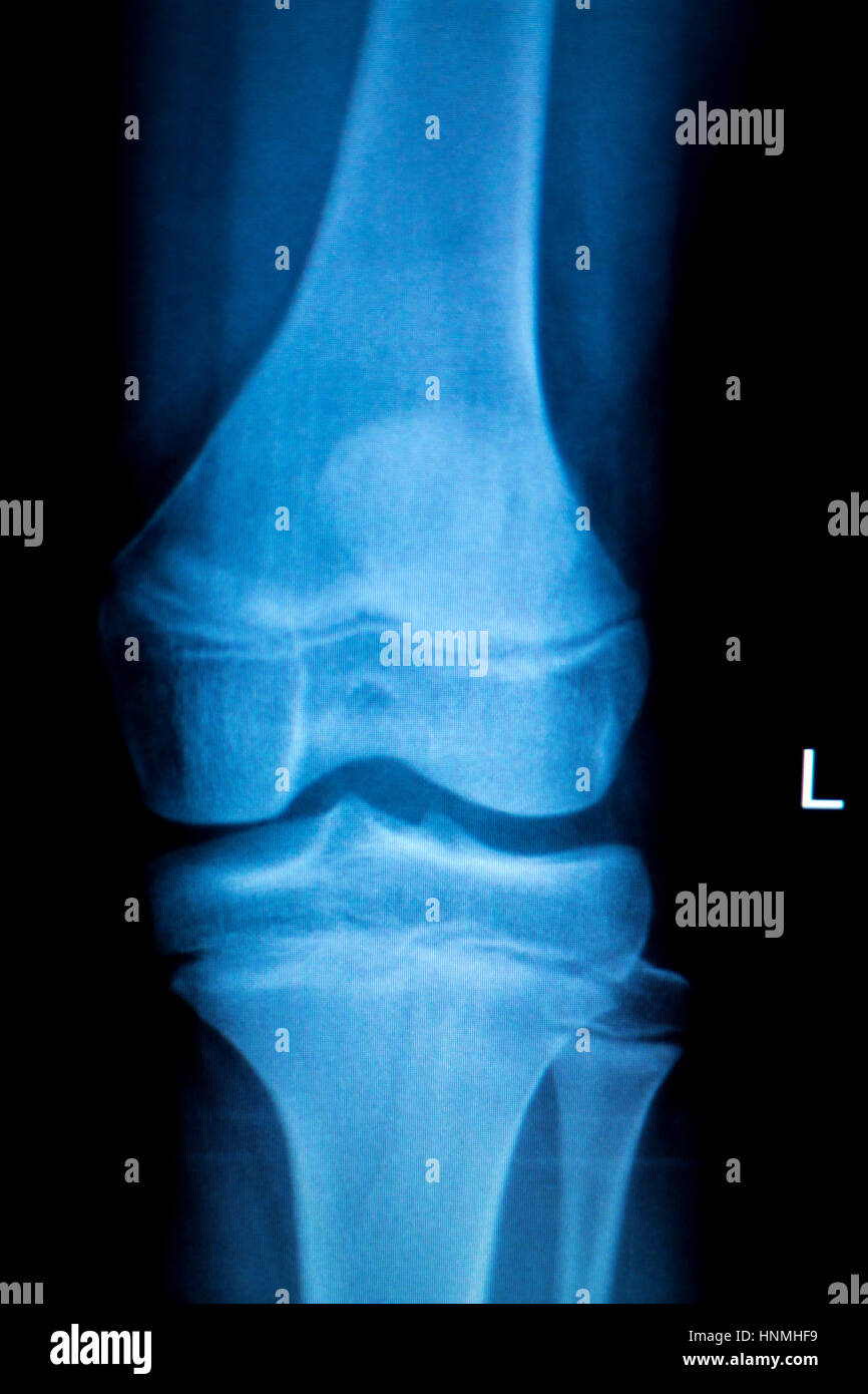 Orthopedics knee joint meniscus, ligament, tendon and cartilage injury ...