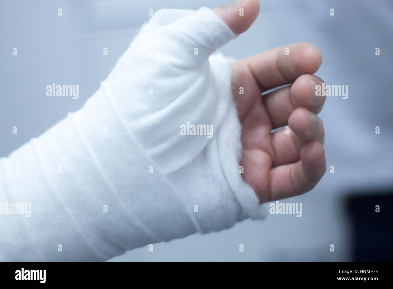 Doctor applying a plaster cast and bandages to patient forearm and ...