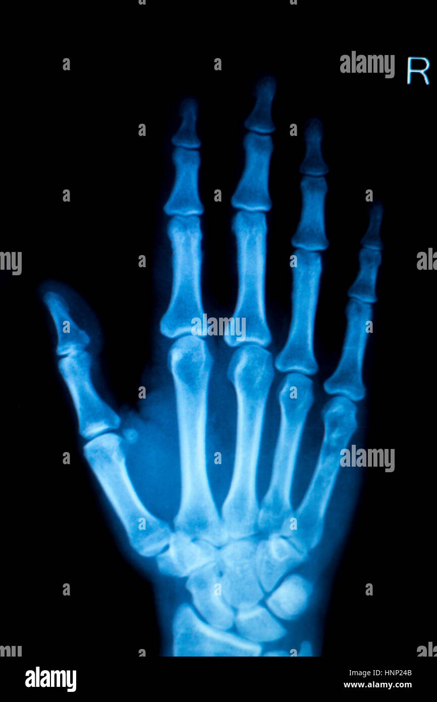 Orthopedics Hand finger joint meniscus, ligament, tendon and cartilage ...