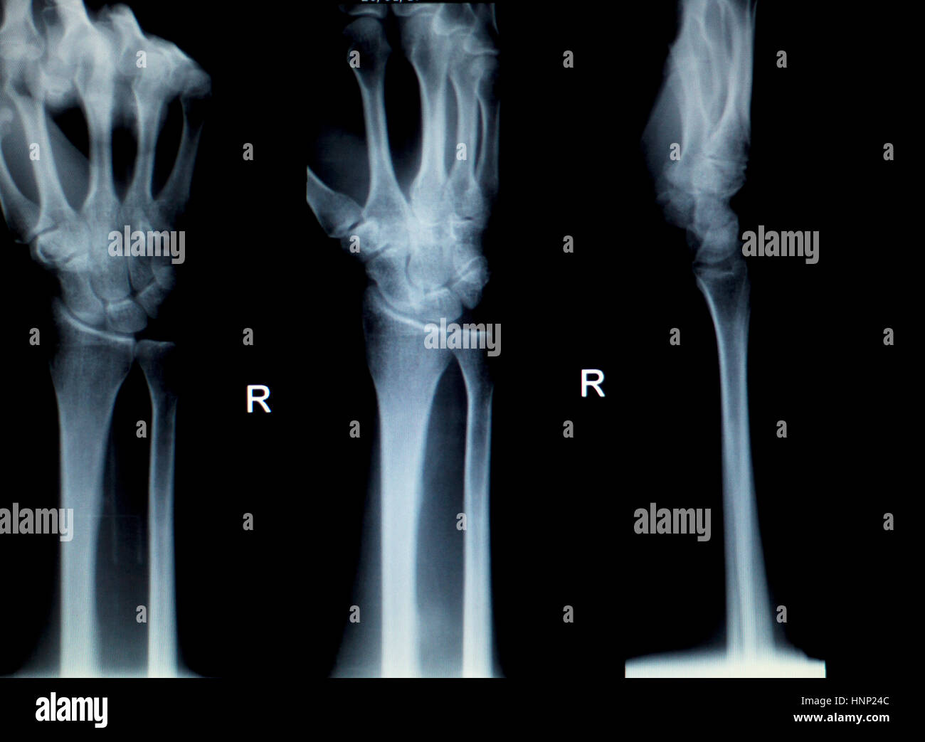 Orthopedics Hand finger joint meniscus, ligament, tendon and cartilage ...