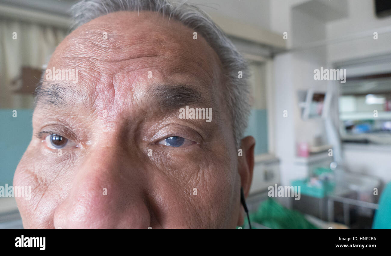 keratopathy bullous condition in eye of elderly patient before ...