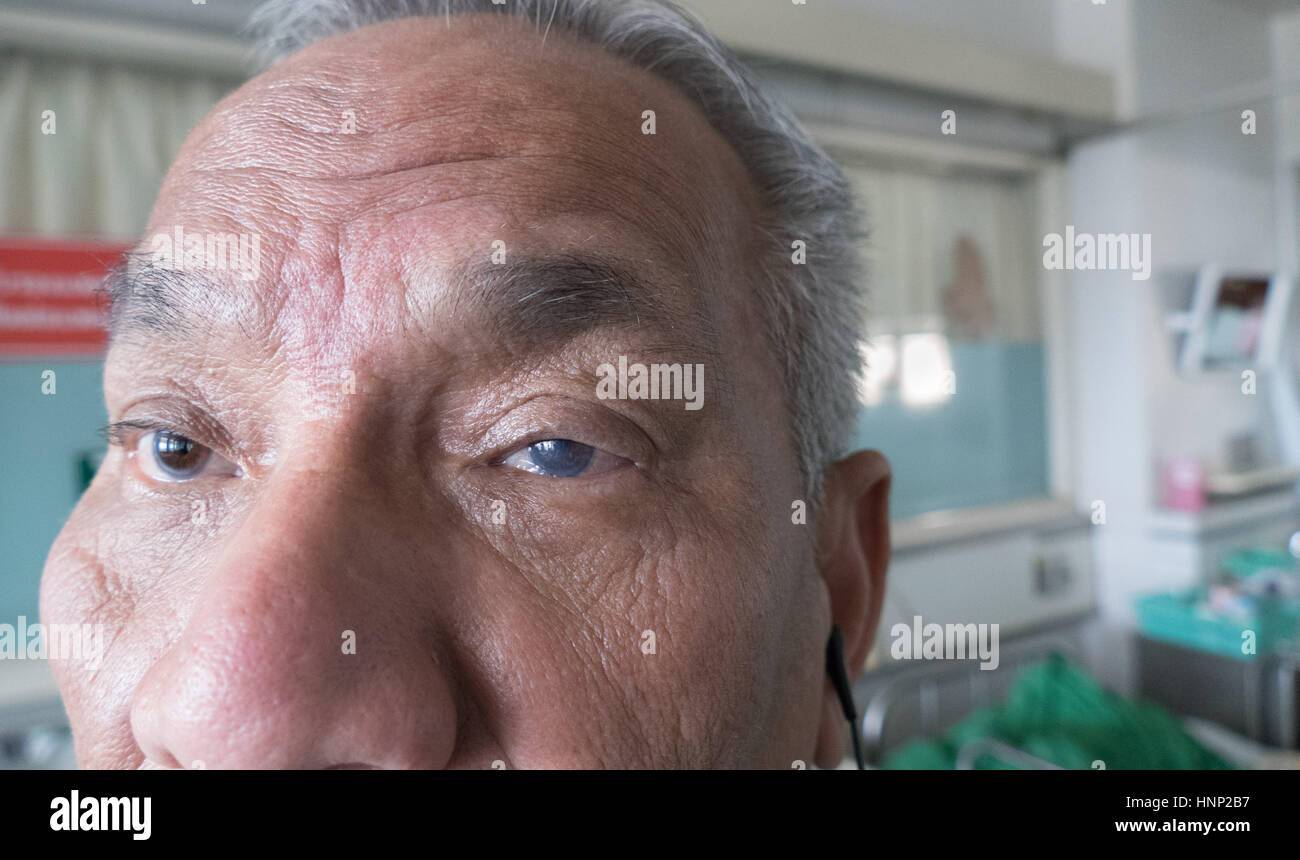 keratopathy bullous condition in eye of elderly patient before ...