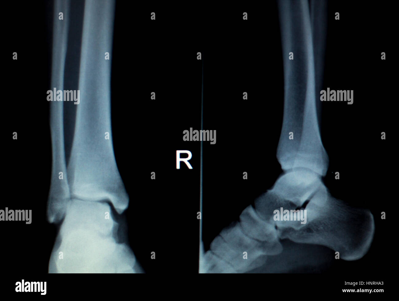 Xray foot heel ankle test scan results showing orthopedic titanium ...