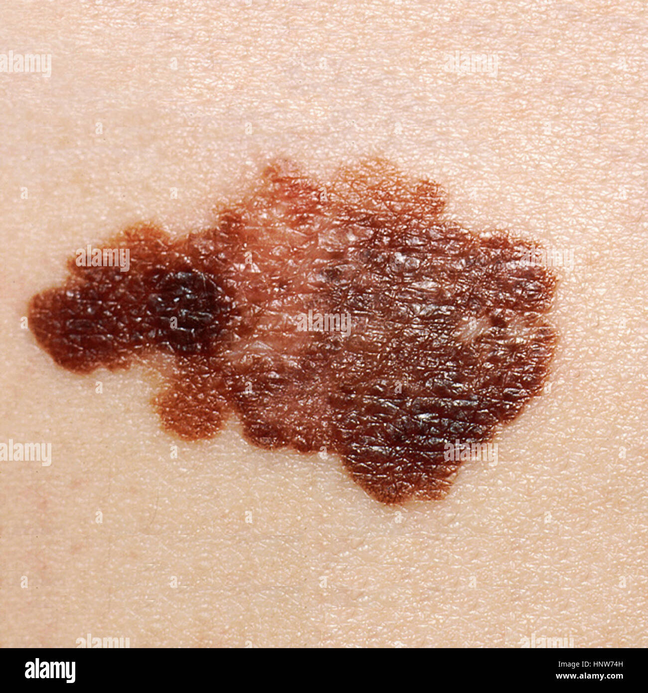 Skin cancer hi-res stock photography and images - Alamy